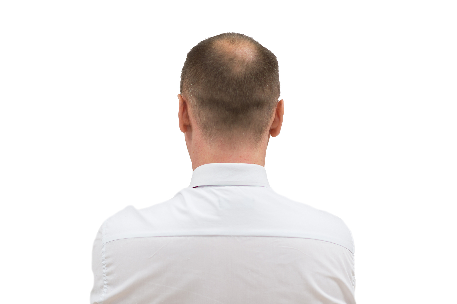 Erblich bedingter Haarausfall • Haarausfall Hilfe