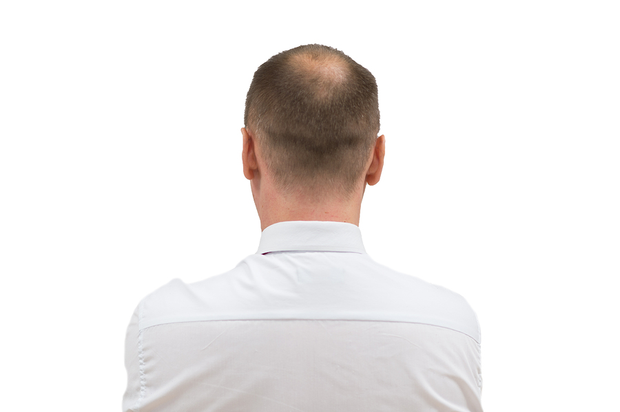 Haarausfall Männer - Ursachen • Haarausfall Hilfe