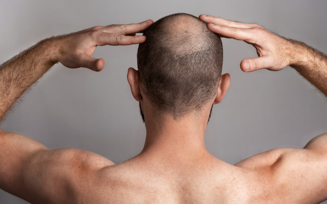 Gegen Haarausfall Männer! Auf in den Kampf • Haarausfall Hilfe